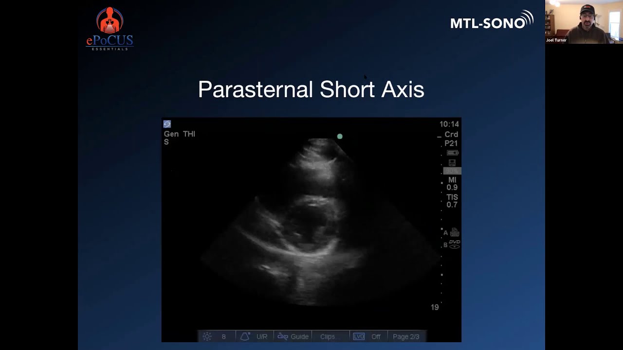 POCUS Series: Right ventricle