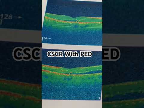 Central serous Chorioretinopathy/Opthalmology Short Cases #doctor #eyes #eyedisease #optometry #cscr