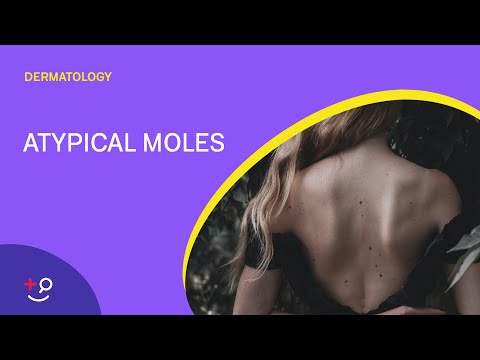 Atypical Moles - What Are They? [Dermatology] (2018)