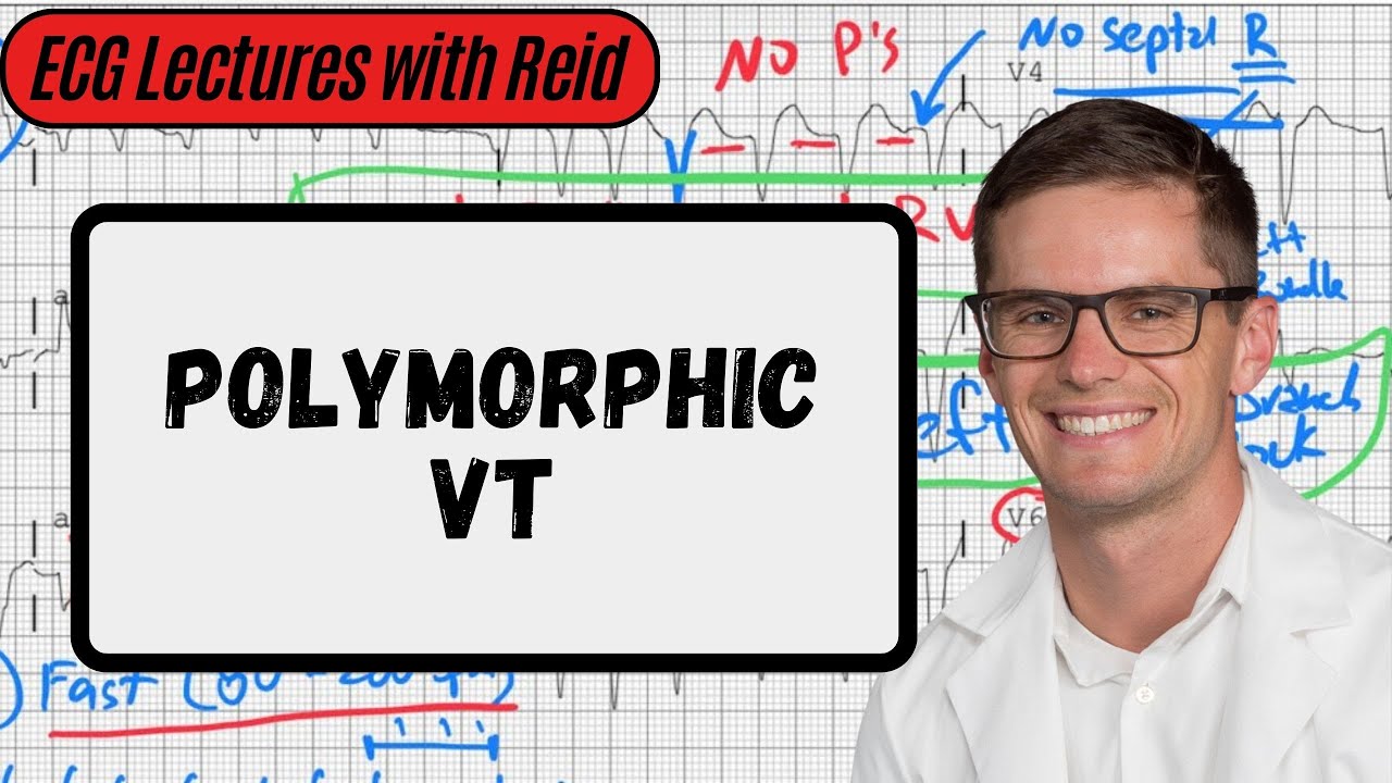 Polymorphic Ventricular Tachycardia | Day 23 ECG Challenge