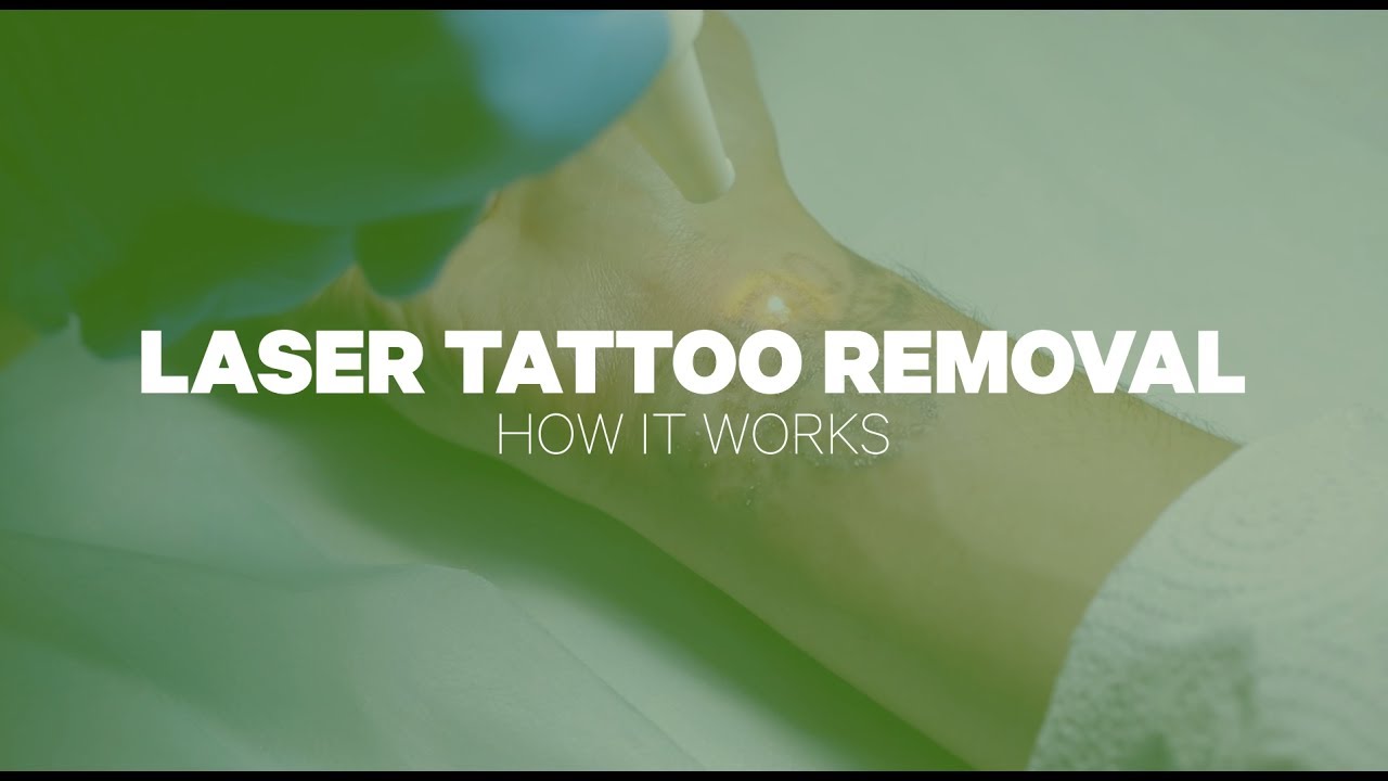 Erased Laser Tattoo Removal - From $60.75 - Las Vegas | Groupon