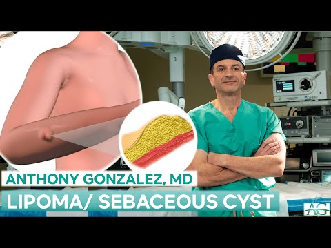 Lipoma/ Sebaceous Cyst and Treatment (English)