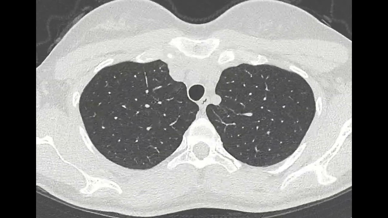 Bronchial/segmental Anatomy on CT scan for Navigation Bronchoscopy