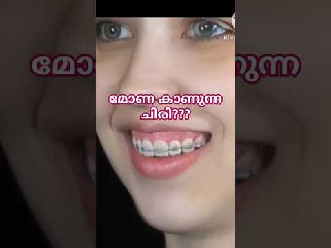 Gummy smile ശരിയാകാം / #braces #palludr #dentist #malayalam #pallilkambiidunnath #viral #shorts