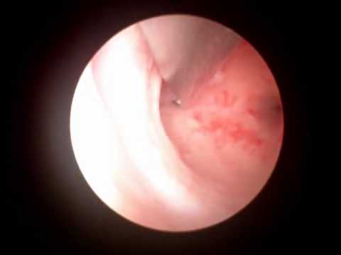 Polyp 3cm