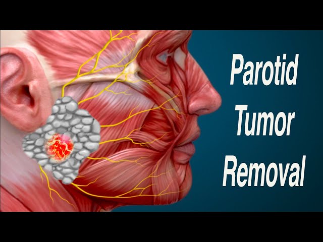 Parotid Tumor