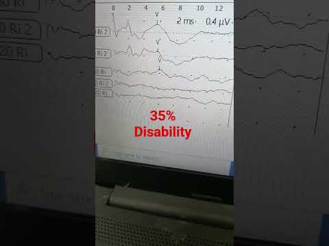 Hearing Test#bera test for hearing disability benefits