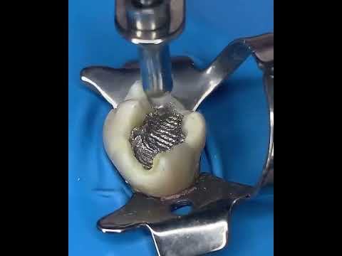Tooth Fillings: The Good, The Bad & The Ugly
