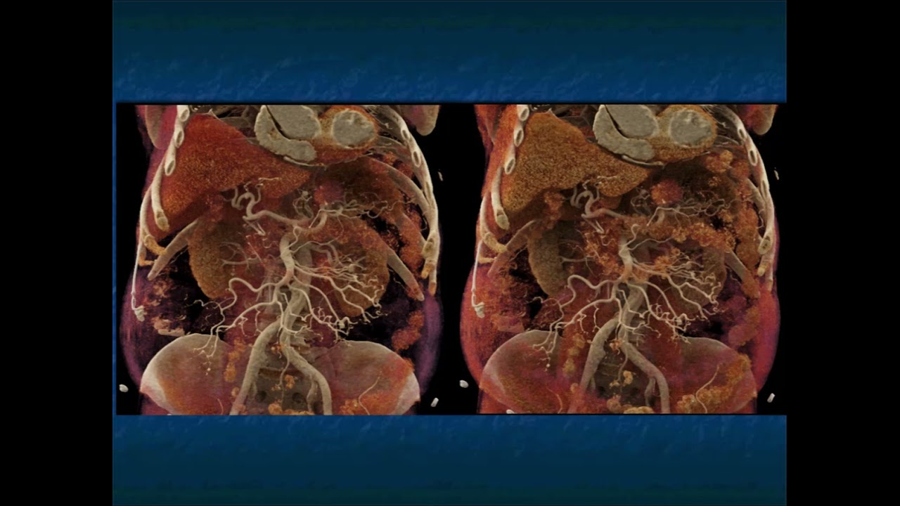 CT Evaluation of Vasculitis: Key Imaging Findings - Part 2