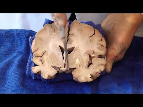 The Visual Pathway: Neuroanatomy Video Lab - Brain Dissections