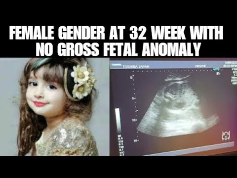 Female Gender At 32 Week With No Gross Fetal Anomaly 😚😚😚