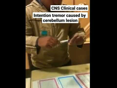 Intentional Tremor