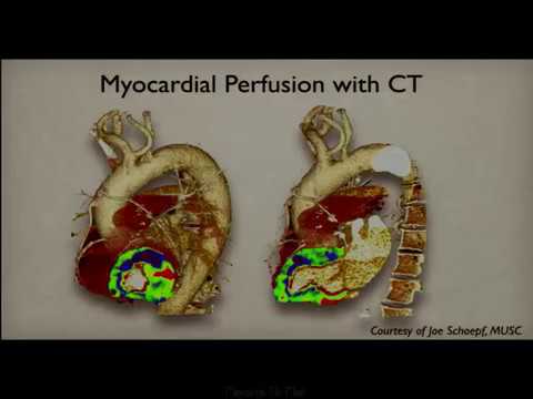 Coronary CTA: Which Lesions are Significant?--Geoff Rubin, MD, MBA (SCBT-MR/SABI 38th Annual Course)