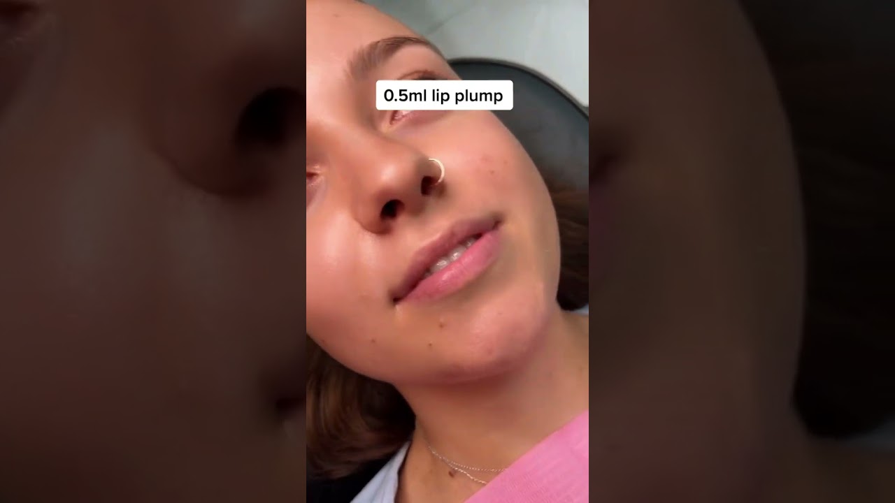 0.5ml lips are a fav #Lipfillerlondon  #aestheticcliniclondon  #shorts