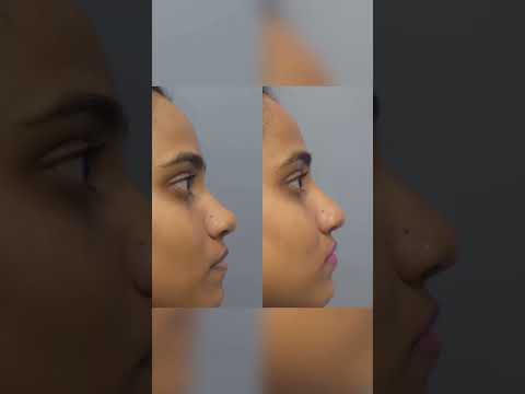 "The Future of Nose Reshaping: 5 Facts About Non-Surgical Rhinoplasty!"