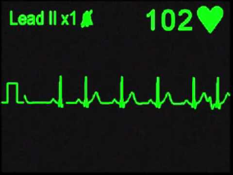 Premature Atrial Contractions (PACs) - ECG Simulator - Arrhythmia Simulator
