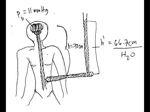 SKETCH ON WATER MANOMETER USED TO MEASURE CSF PRESSURE