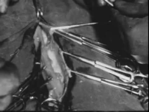Cholecystectomy (1929) Pt. 1 of 5