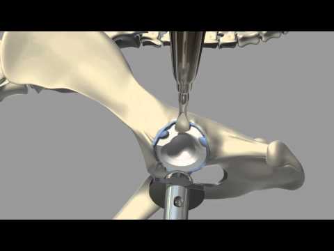 Total Hip Replacement