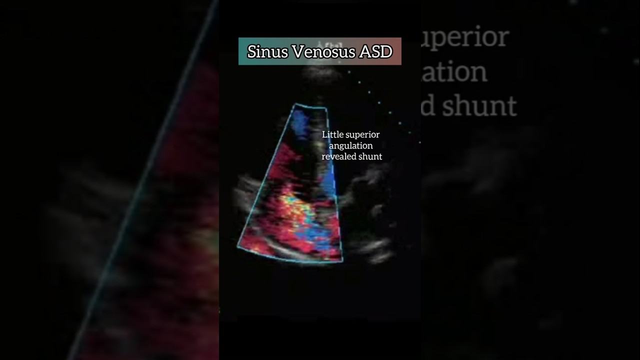 Sinus Venosus ASD on Echocardiogram #heart #cardiology