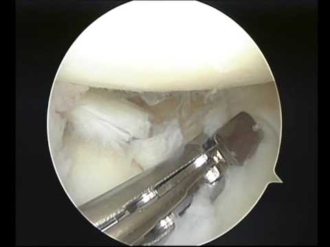 Discoid meniscus rupture Partial meniscectomy Bancha Chernchujit.wmv