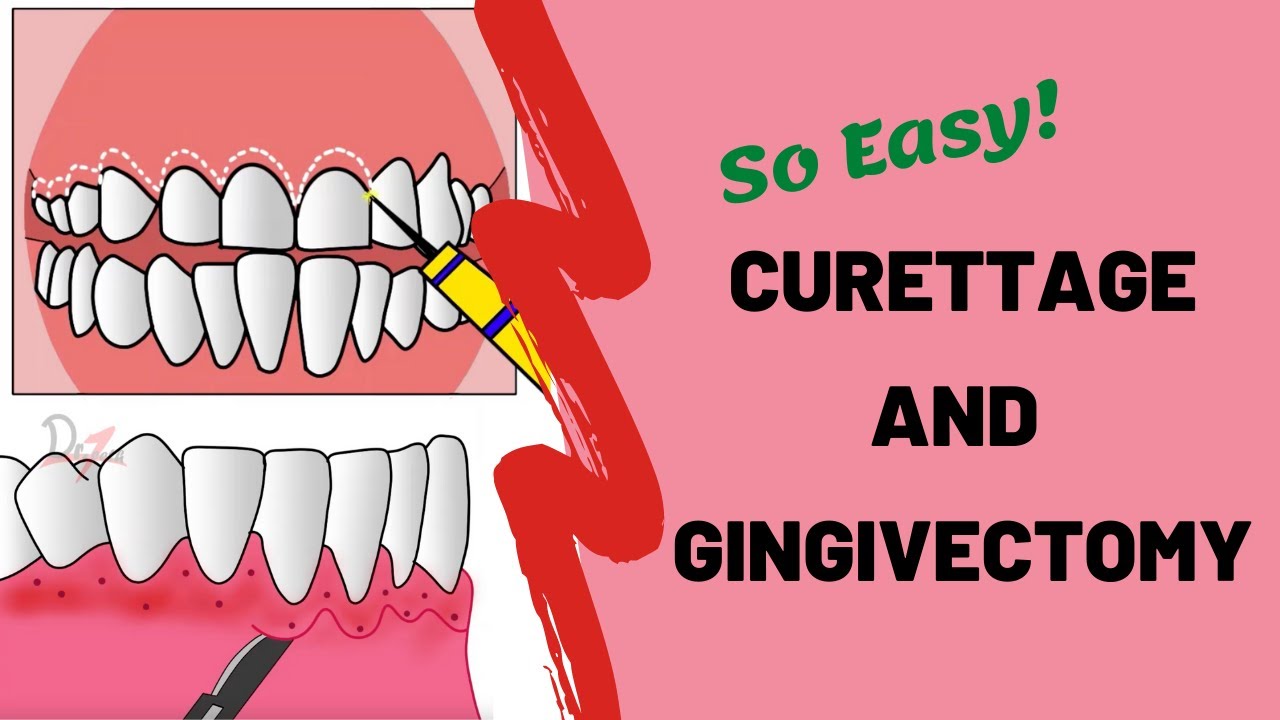 Gingival Curettage and Gingivectomy | PERIODONTOLOGY