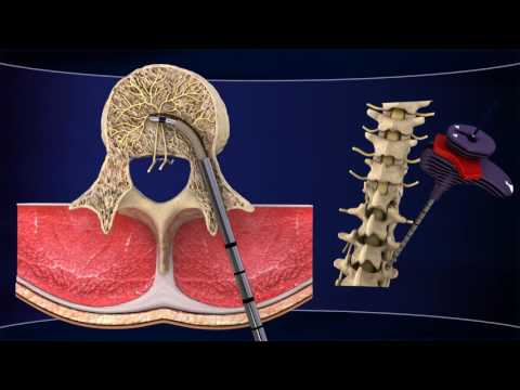 INTRACEPT Intraosseous Nerve Ablation System