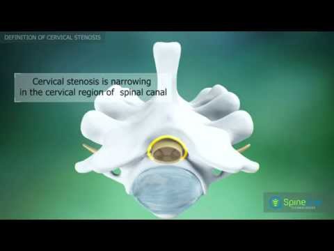 Cervical Stenosis. Definition