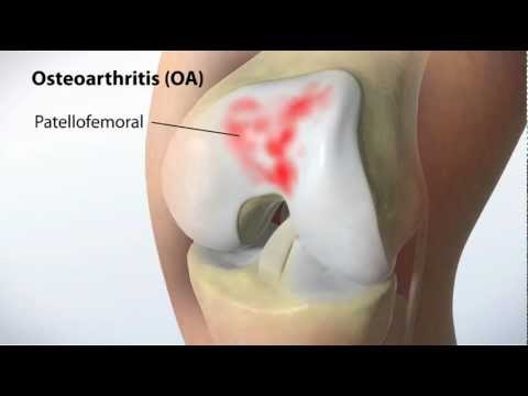 Lourdes MAKOplasty Procedure Animation