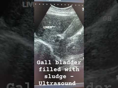 GB sludge Ultrasound #education #ultrasound #study #abdomen #anatomy #sonography #sludge #liver