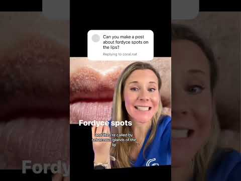 Curious about these little spots on your lips? #fordycespots #lips