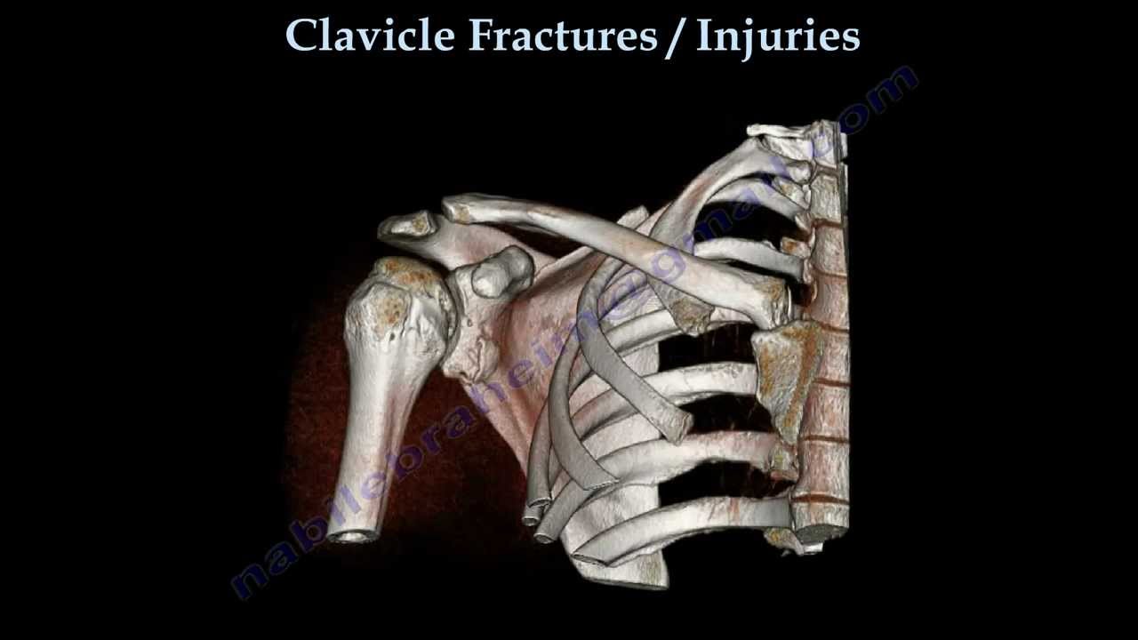 CLAVICLE FRACTURE  treatment and repair - Everything You Need To Know - Dr. Nabil Ebraheim