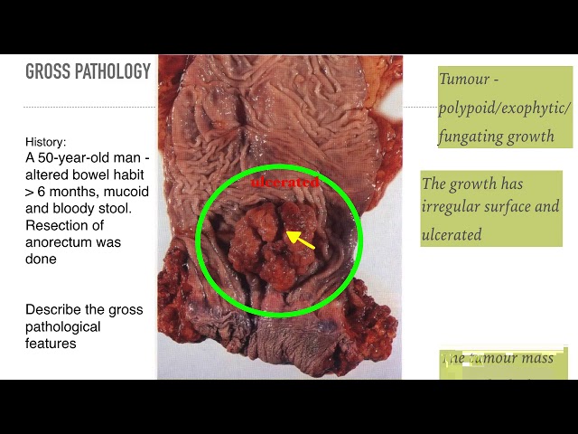 Understanding the Pathology of Colorectal Cancer: A Comprehensive ...