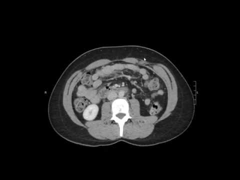 Normal CT Abdomen/Pelvis