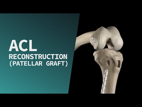 ACL Reconstruction (Patellar Graft)