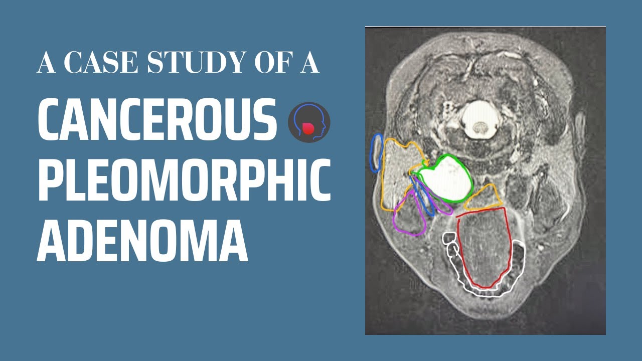 Can benign parotid tumors turn cancerous? | Pleomorphic adenoma case study