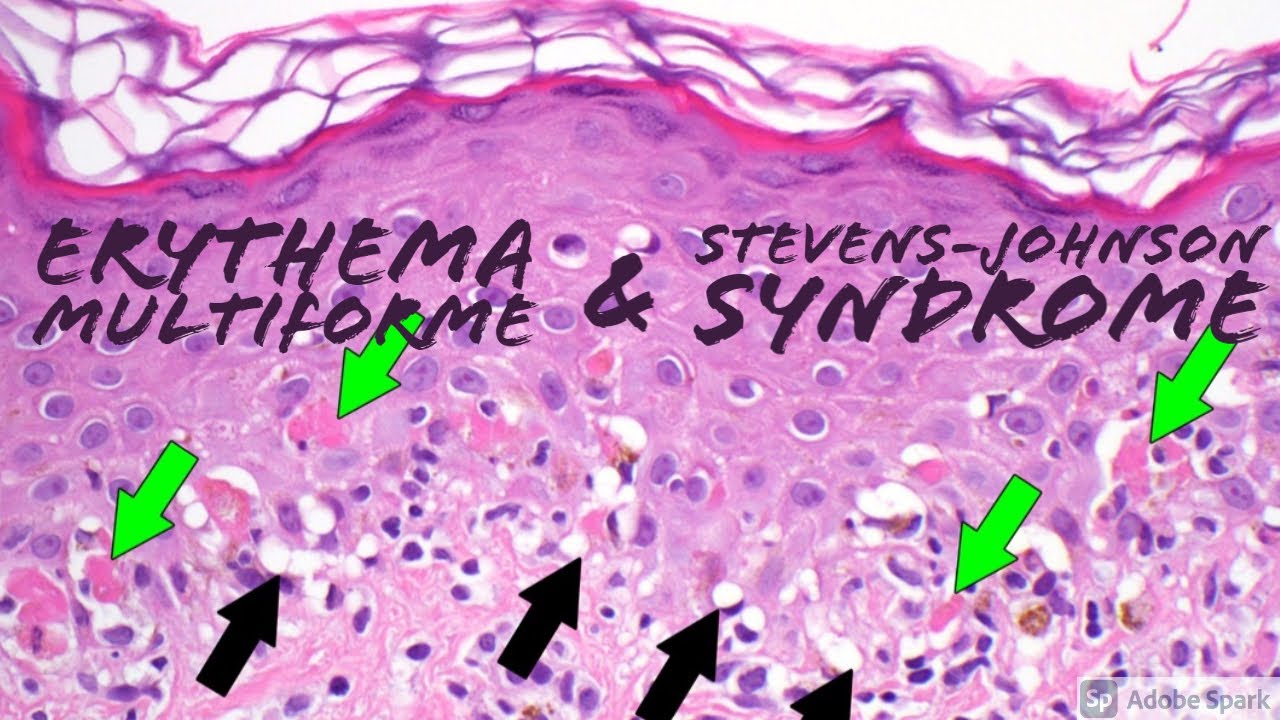 Stevens-Johnson Syndrome/Toxic Epidermal Necrolysis (SJS/TEN) & Erythema Multiforme Dermpath