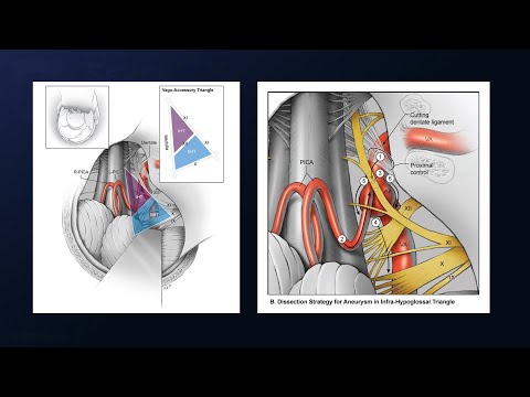 Far Lateral Craniotomy for Trapping of a Ruptured Dissecting V4 Vertebral Artery Aneurysm