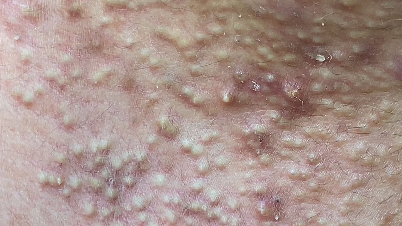 Acne Treatment For 