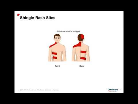 Webinar | Shingles: Do you know what signs to look for?