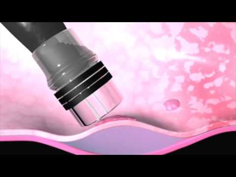 Barrett's Esophagus Endoscopic Resection