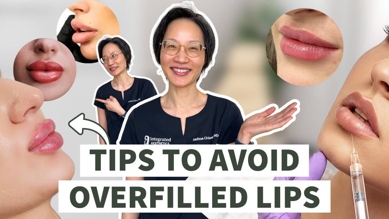 Natural-Looking Lip Fillers: How to Achieve Subtle Enhancement
