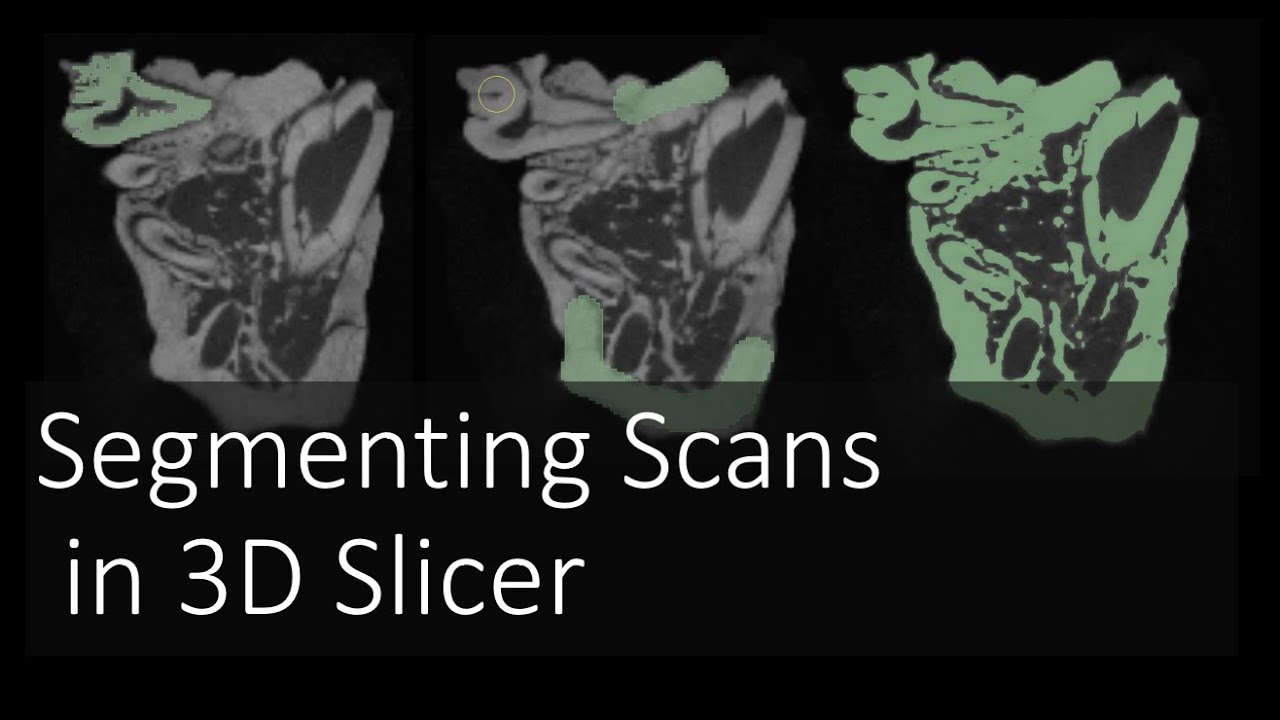 Segmenting Scans in 3D Slicer | Introduction to Digital Preparation Video 11
