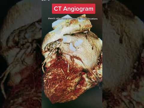 What is a cardiac CT angiogram? What doesvaCTv Angiogram look like? #ccta #cta #coronaryct #coronary