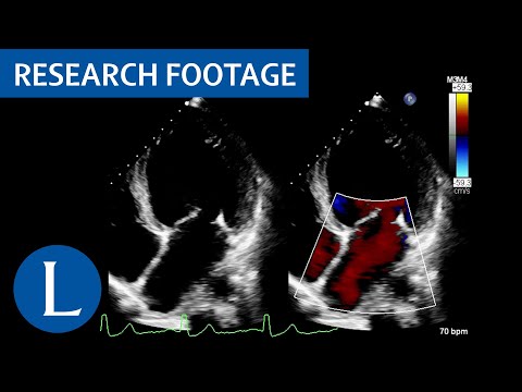 Dilated left ventricle with global hypokinesia. Libman-Sacks endocarditis: 1 of 4