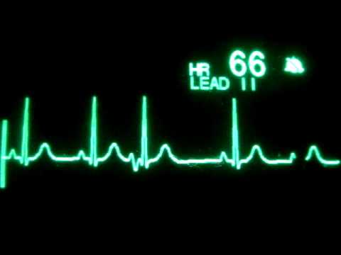 Premature Atrial Contraction / Complex (PAC)