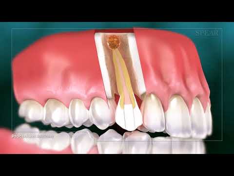 Apicoectomy