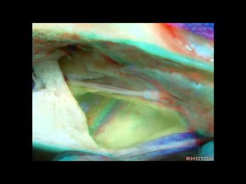 Menavigasi Tulang Temporal (3D) - Bagian 2 dari 3