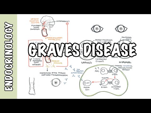 Graves Disease - Overview (causes, pathophysiology, investigations and treatment)