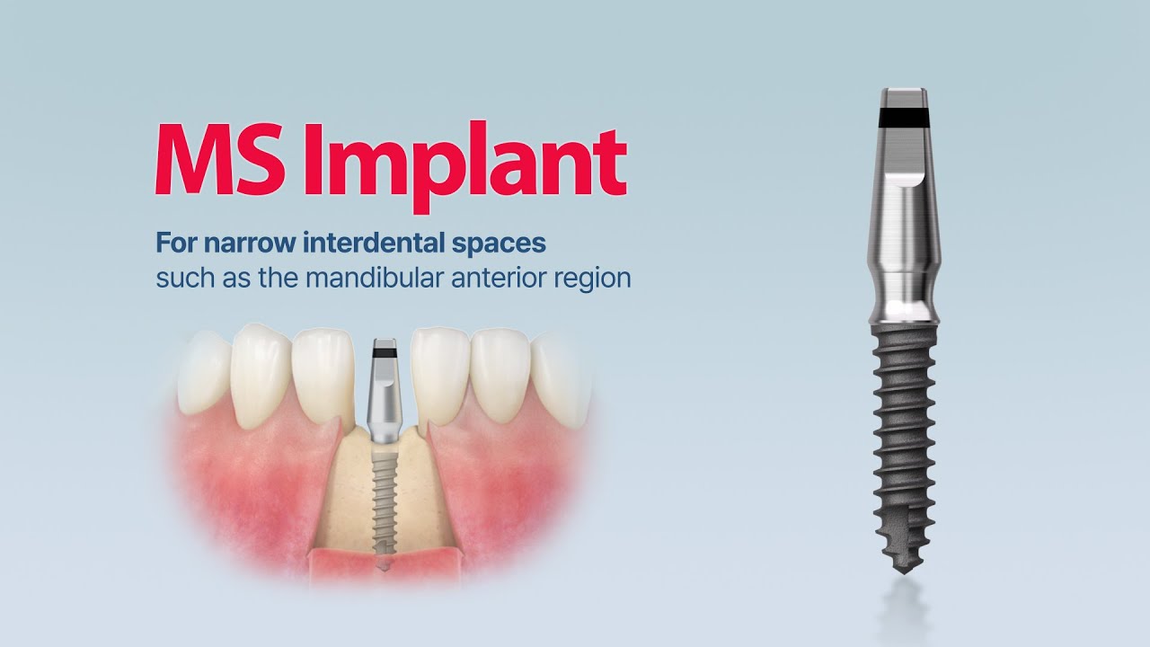 “MS Implant” for narrow bone